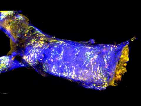 Atherosclerotic artery