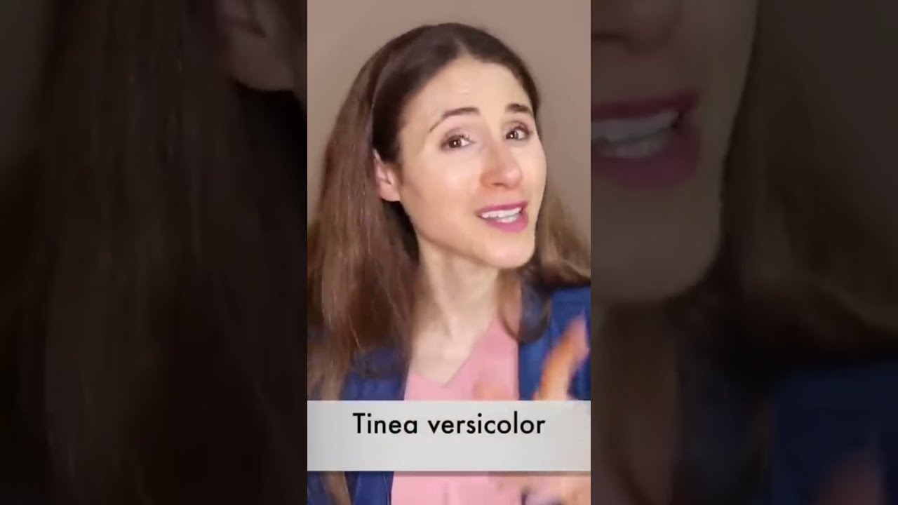 Tinea versicolor #dermatologist @DrDrayzday