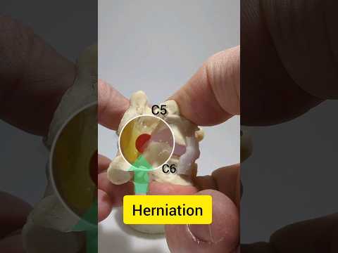 Cervical Disc Herniation C5-6 Model