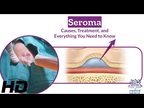Seroma Breakdown: Causes, Treatment Options, and Essential Tips
