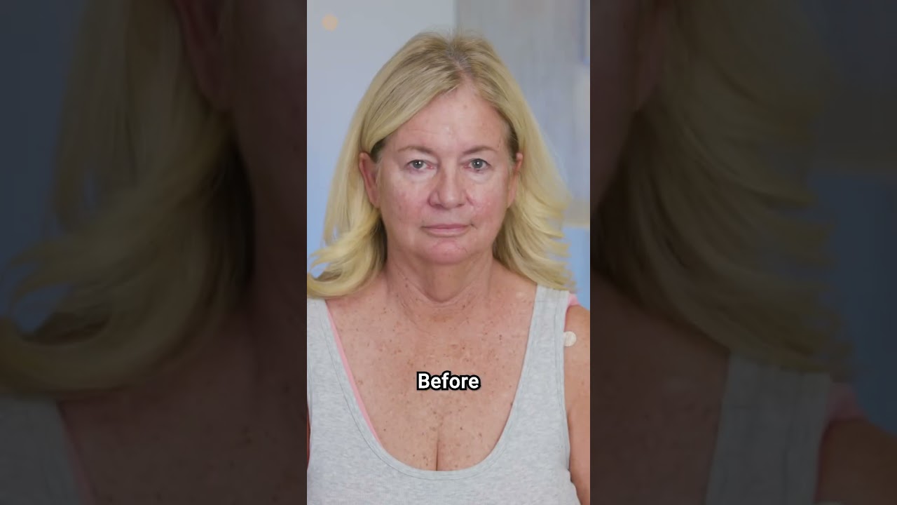 Best Deep Plane Facelift Results #deepplanefacelift #cosmeticsurgery
