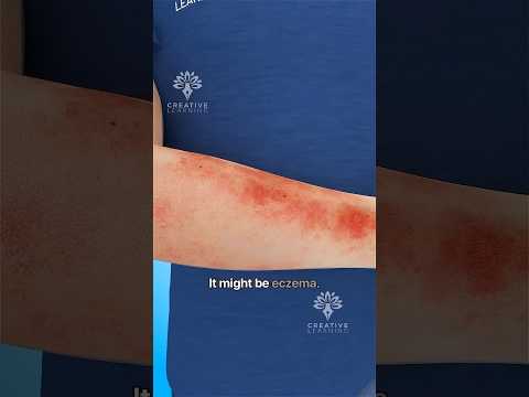 Why Does Eczema Happen #shorts #viralvideo - Creativelearning3d