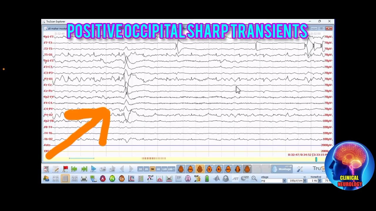 EEG showing positive occipital sharp transients of sleep ( POSTS) #eeg #doctor #epilepsy #neurology