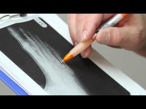 Stress Fractures, Dr. Brian Gale, DPM, FACFAS, Dakota Foot & Ankle Clinic, Bismarck, North Dakota
