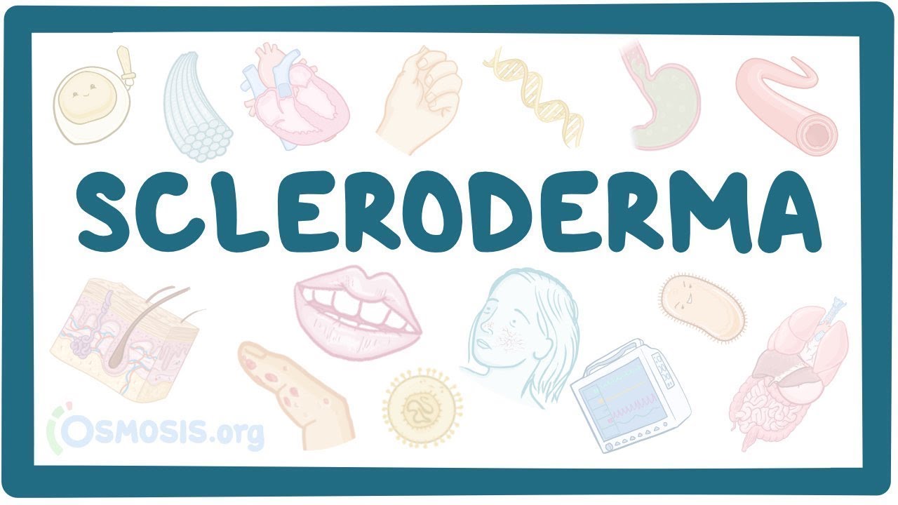 Scleroderma - an Osmosis Preview