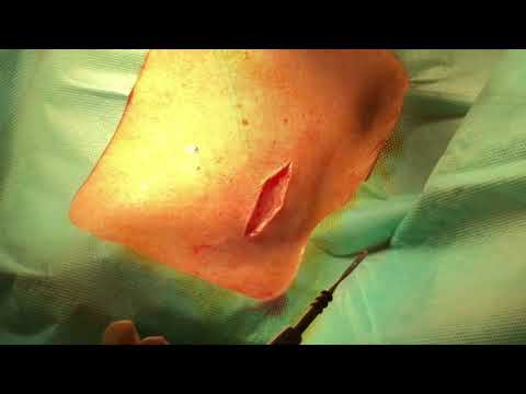 Implantable venous access device placement (IVAD) using the cephalic vein