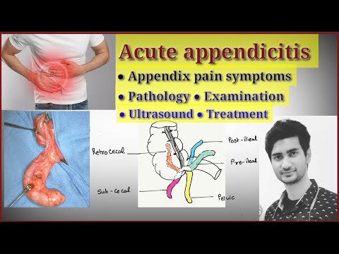 Acute appendicitis | Appendix pain symptoms | Pathology | Examination | Ultrasound | Treatment/ FMGE