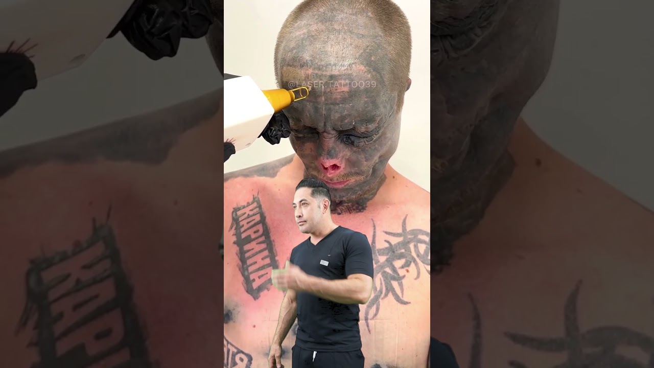 O Dr. enfim encontrou a sua cara metade | Remoção de Tatuagem