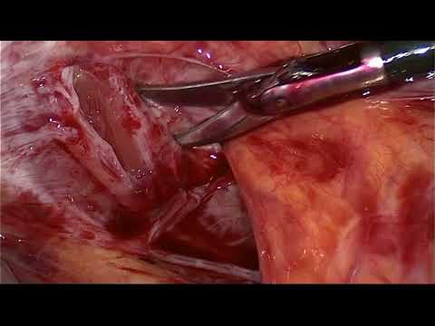 Laparoscopic Reversal of Hartmann Procedure