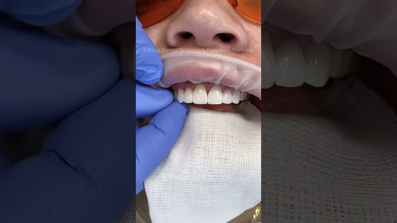 A combination of porcelain bridges & veneers to replace missing teeth & create a wider smile 🤍