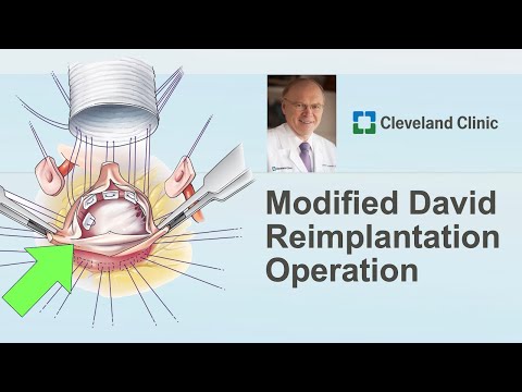Surgeon Q&A: Modified David Reimplantation Procedure: What Should Patients Know?
