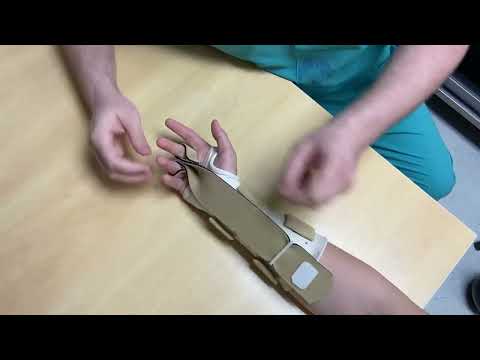 Simplified Dynamic MCP Flexion Splint