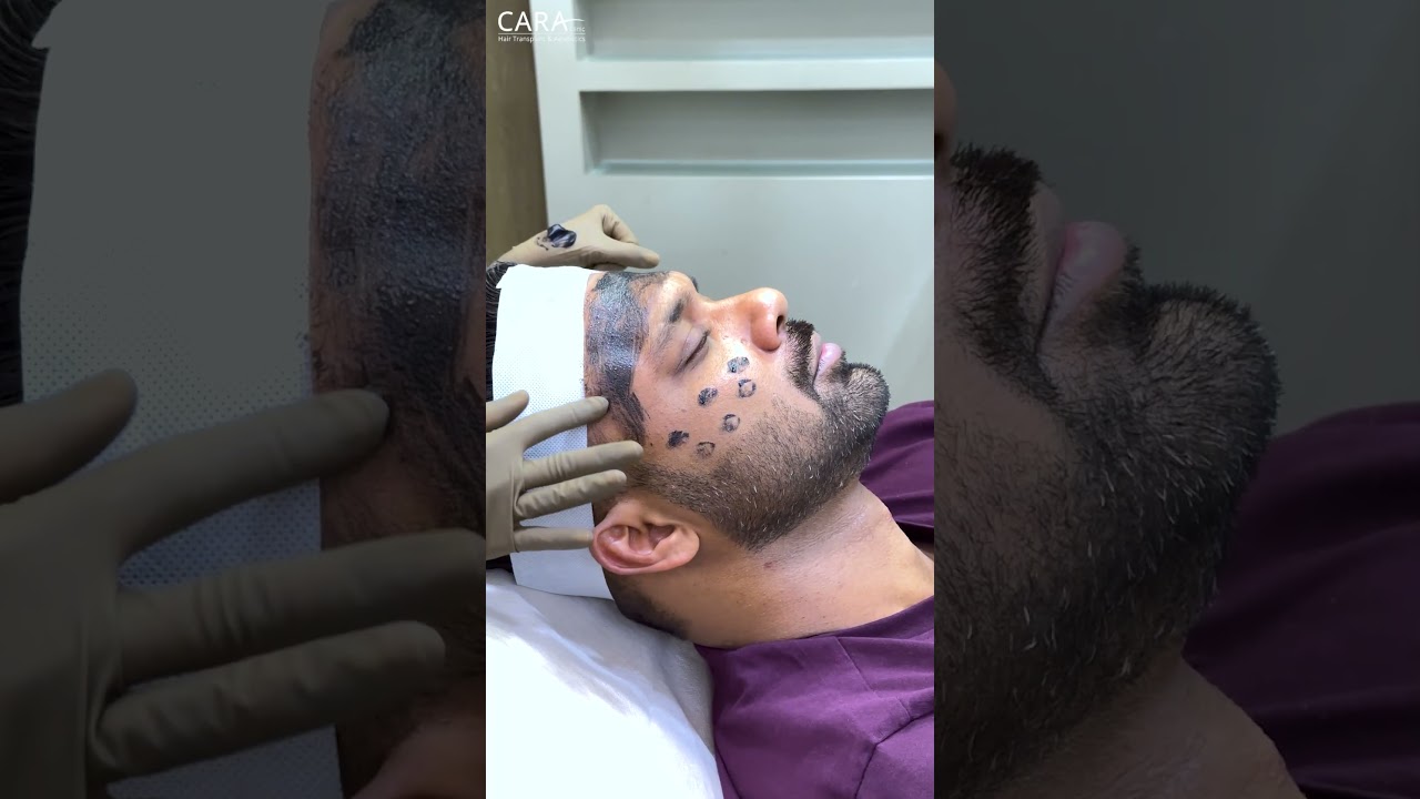 How to Glow up with Pico Carbon Peel at Cara Clinic