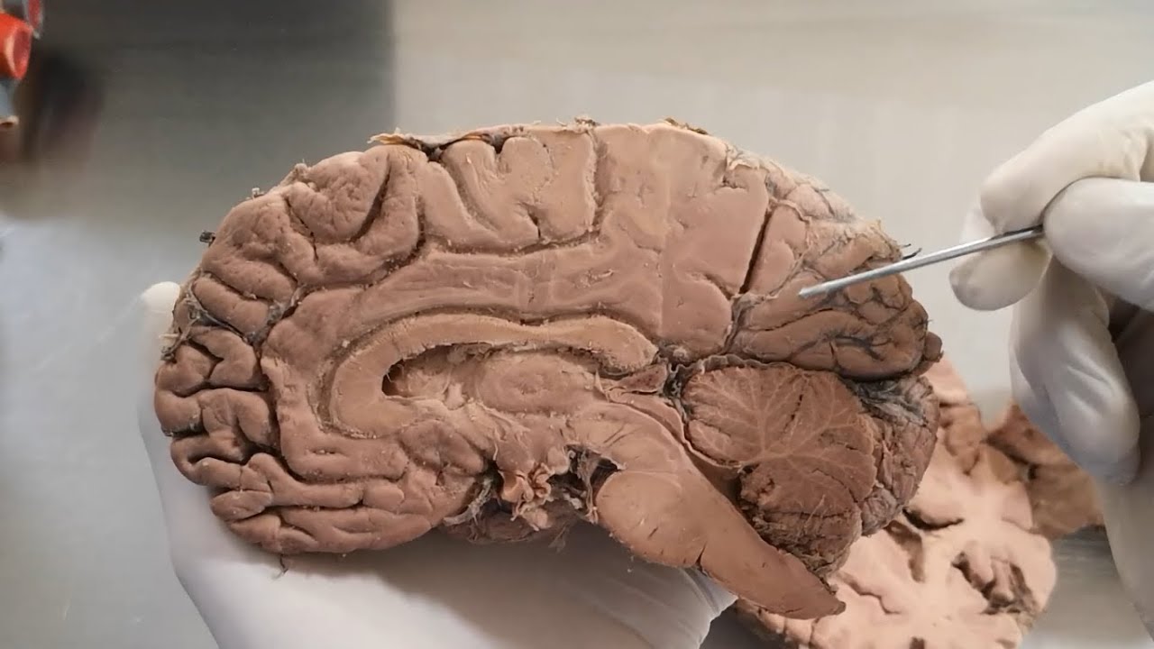 CEREBRO espécimen REAL - NEUROANATOMIA