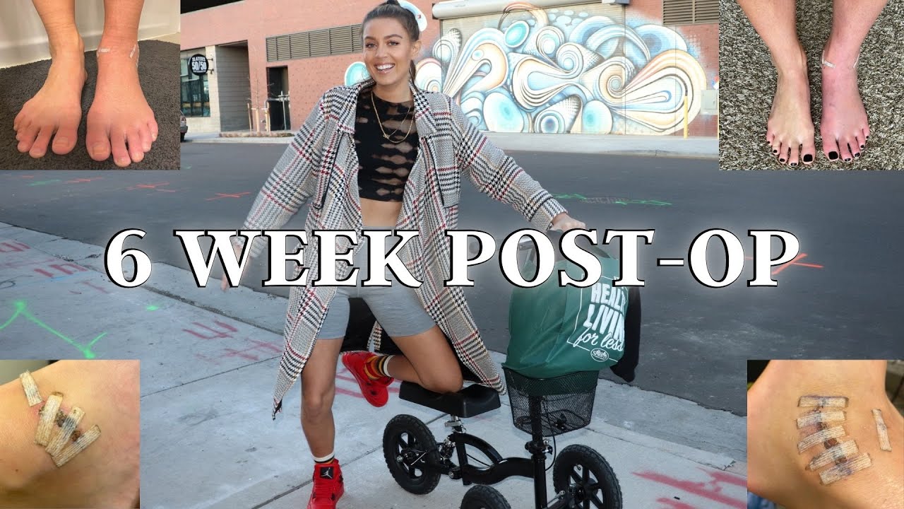 Ankle Surgery | 6 Week Post Brostrom Ankle Surgery Update