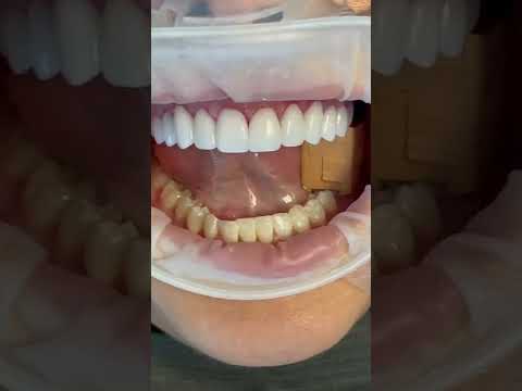 Porcelain Veneers by Dr. Tejas Patel