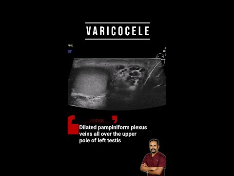 Varicocele - Ultrasound