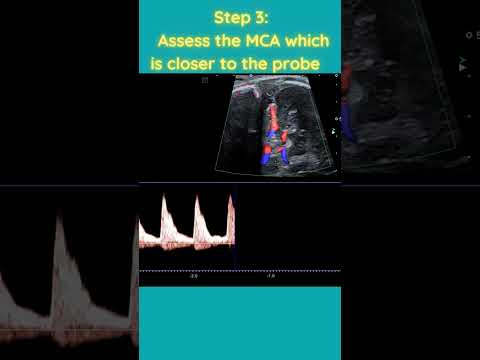 HOW to perform Doppler Ultrasound of Middle Cerebral Artery (MCA).