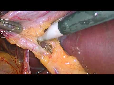 LAPAROSCOPIC CHOLECYSTECTOMY BY DR. AHMAD ALSHABASY - EASY CASE