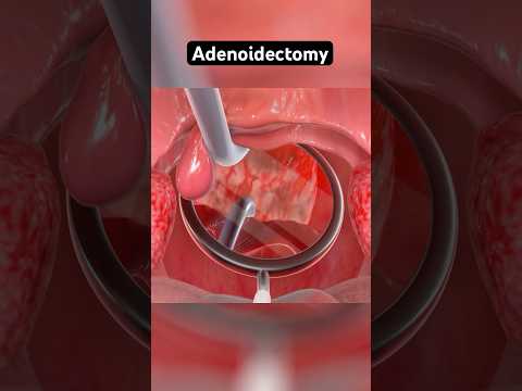 Adenoidectomy explained (3D Animation)