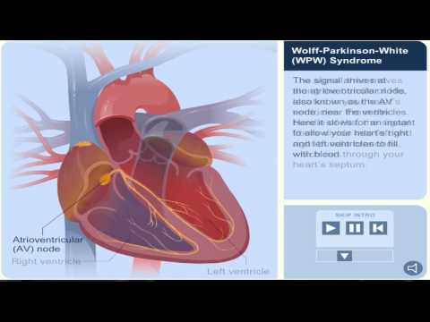 Wolff-Parkinson-White Syndrome