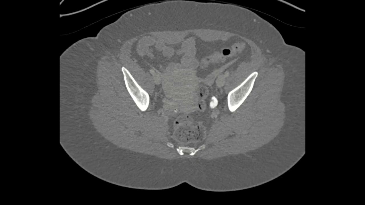 Ureterocele