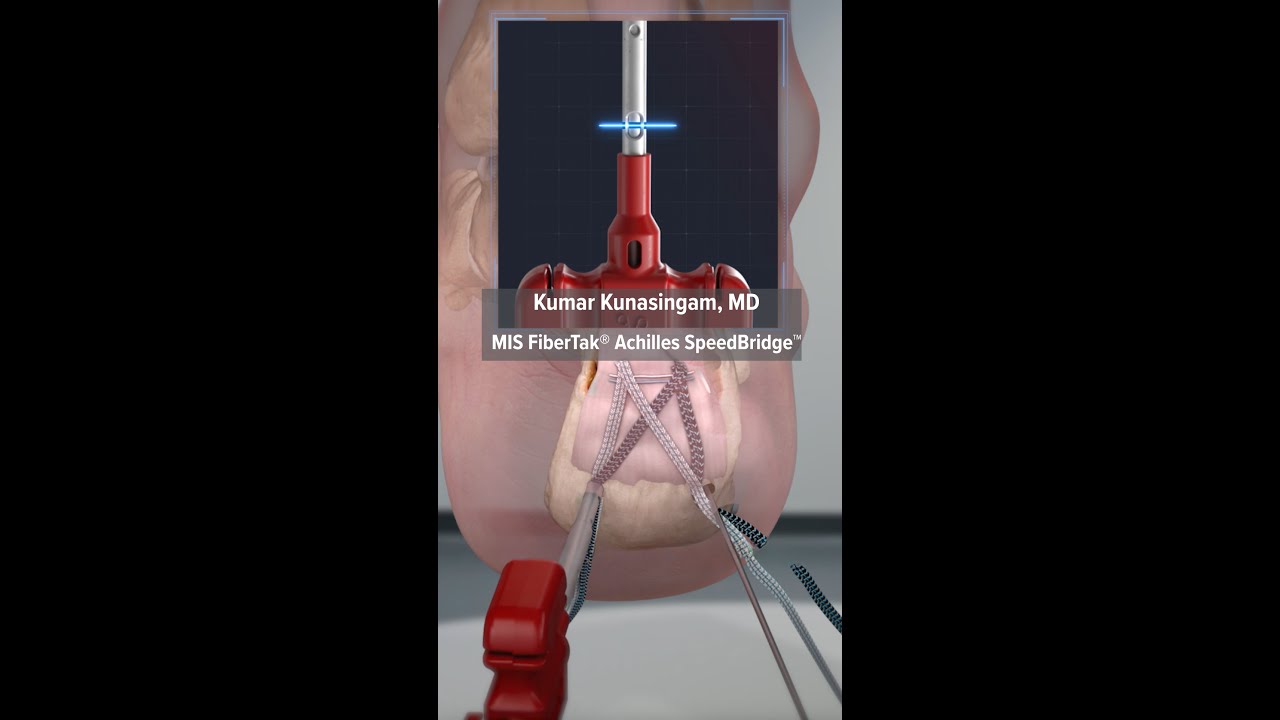 Arthrex MIS FiberTak® Achilles SpeedBridge™