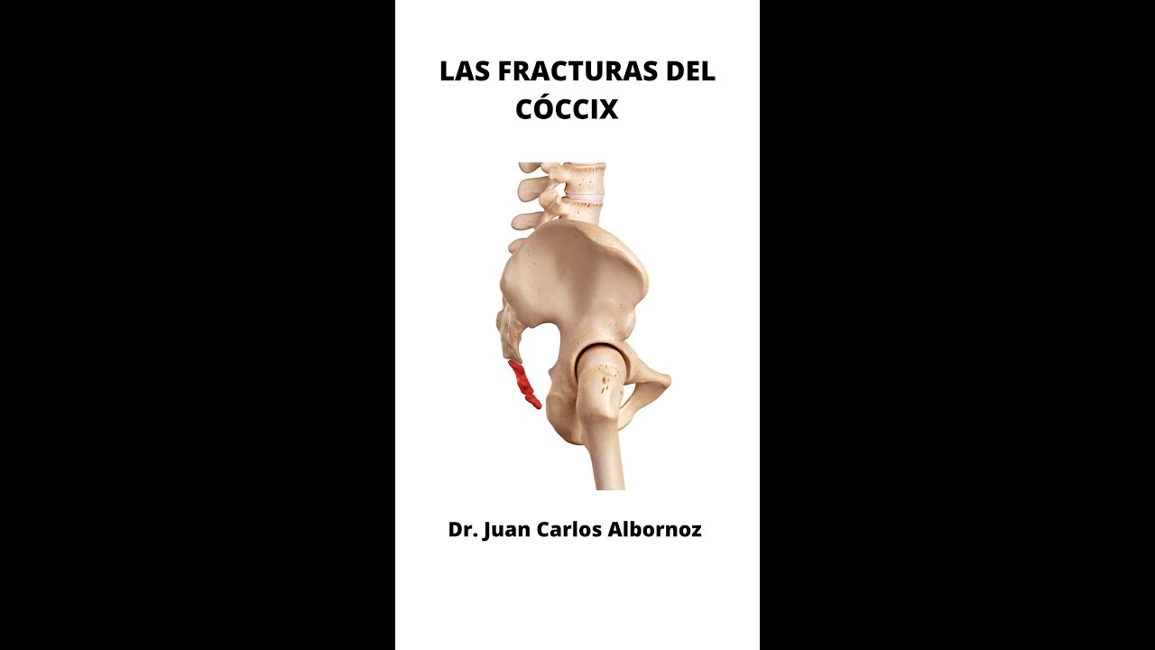 COCCIX FRACTURE #JUANCALBORNOZ #COCCIX #SHORTS