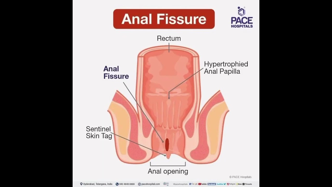 Anal fissure #healthtips #studytips #image #structure