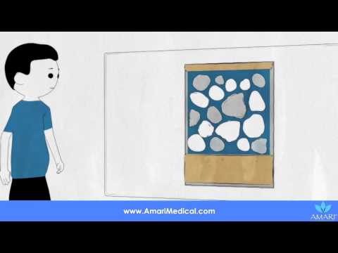 How CoolSculpting Works at Amari Medical in Scarsdale, Westchester, NY