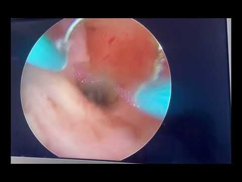 AN HYSTEROSCOPIC RESECTION OF A POLYP IN A VIRGIN PATIENT