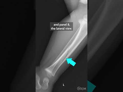 NEJM Images in Clinical Medicine: Toddler’s Fracture