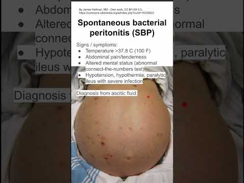 Spontaneous bacterial peritonitis
