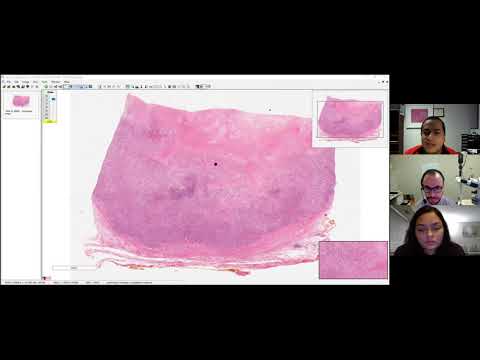 Fresh Air with Sanjay and Matt. Episode 3: Thymic carcinoma, Teratoma, SMARCA4 and NUT
