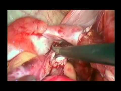 LAP URETRIC REIMPLANTATION 12 25 MIN