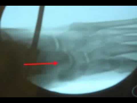 ProStop™ Subtalar Arthroereisis For Correction of Posterior Tibial Tendon Dysfunction