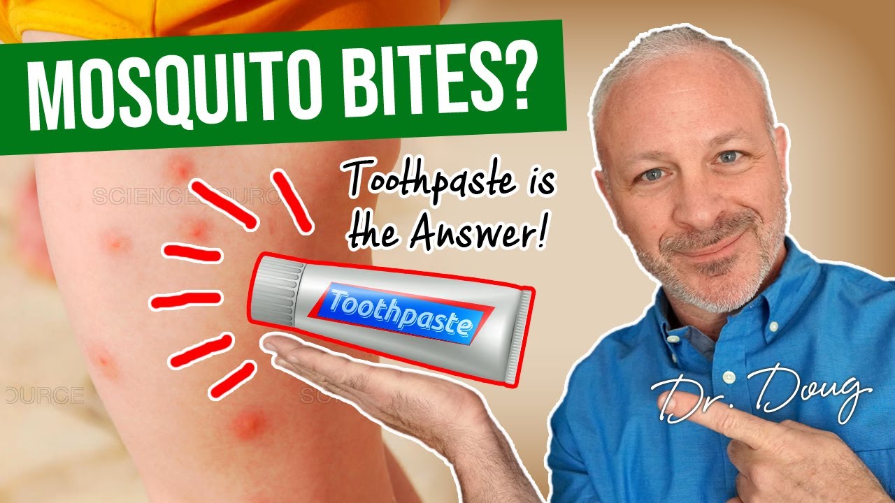 Mosquito Bite Remedy: TOOTHPASTE!  |  Dr. Doug Willen