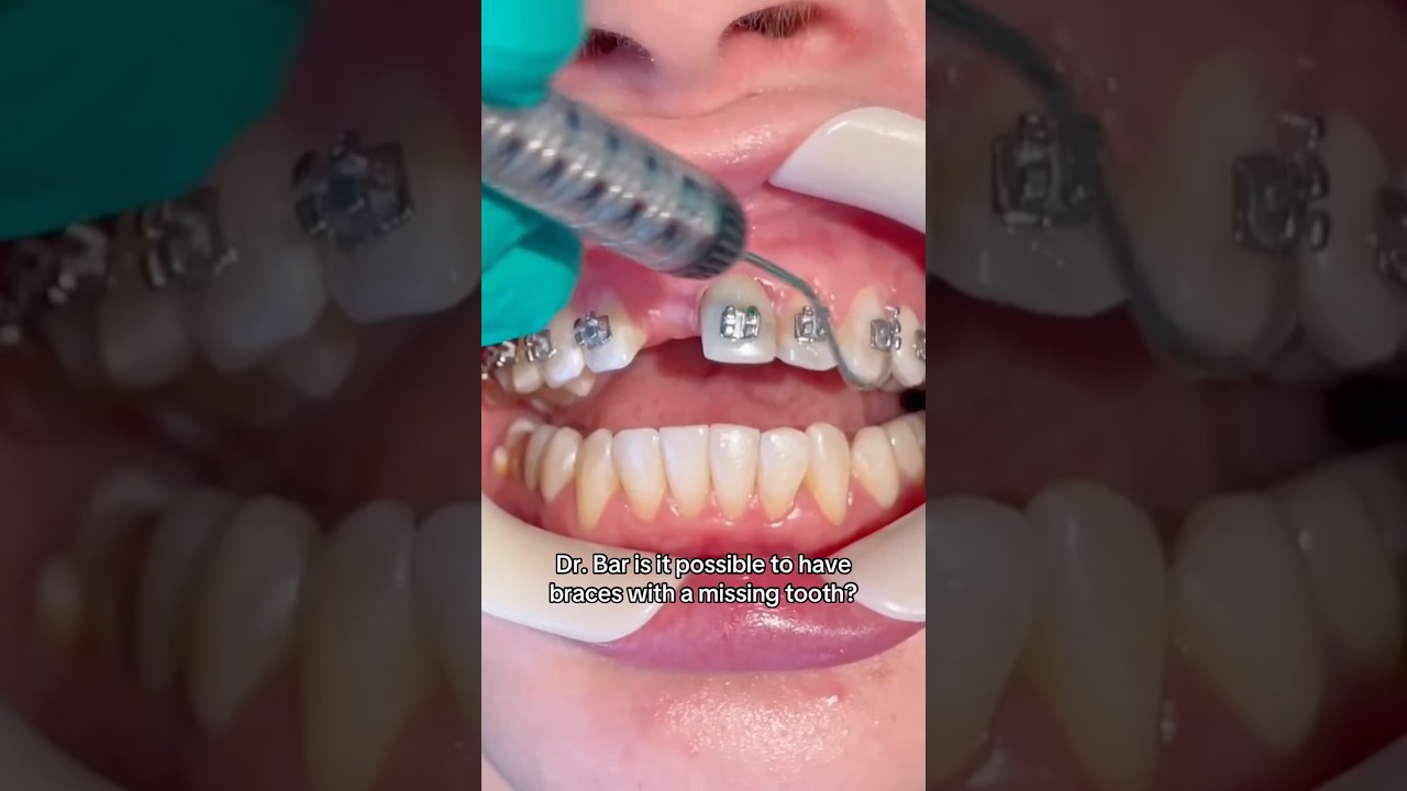 How We Hide A Missing Tooth During Braces