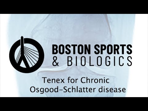 Osgood-Schlatter Disease in Adults: Minimally Invasive Treatment with Tenex