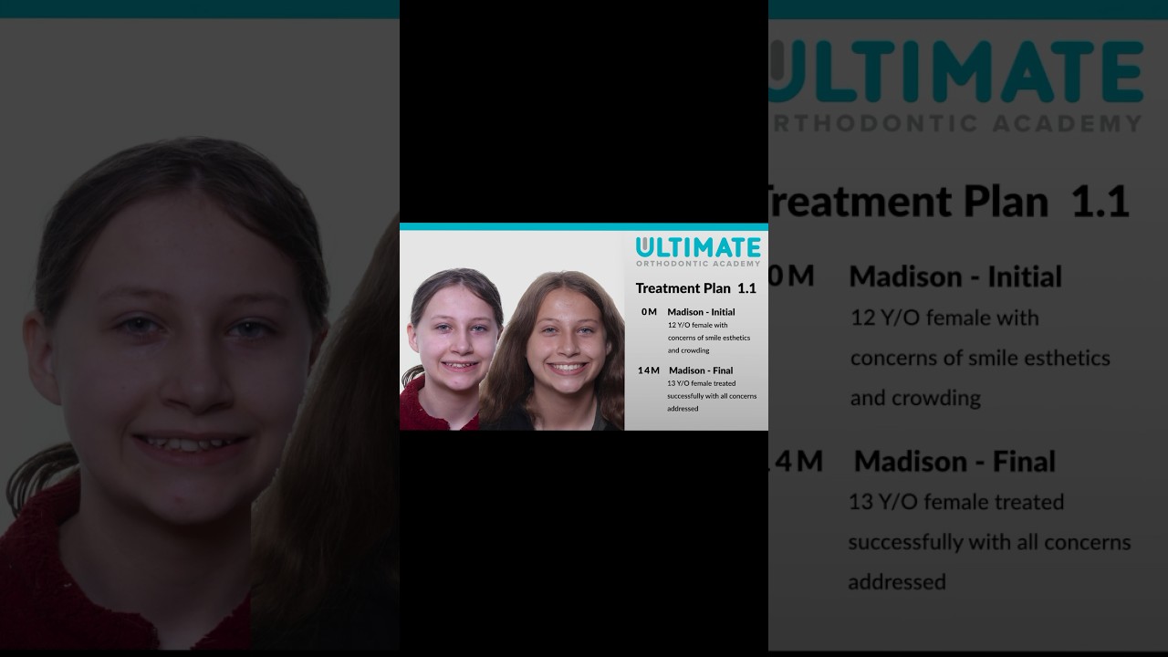 Case Study 2 - Class I Crowding and Rotation with Damon Ultima System #orthodontics #ormco