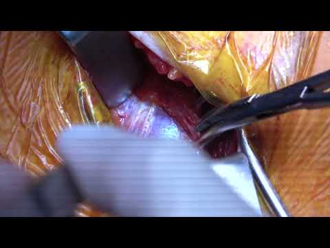 Obstructive sleep apnea surgery: inspire therapy surgical implant