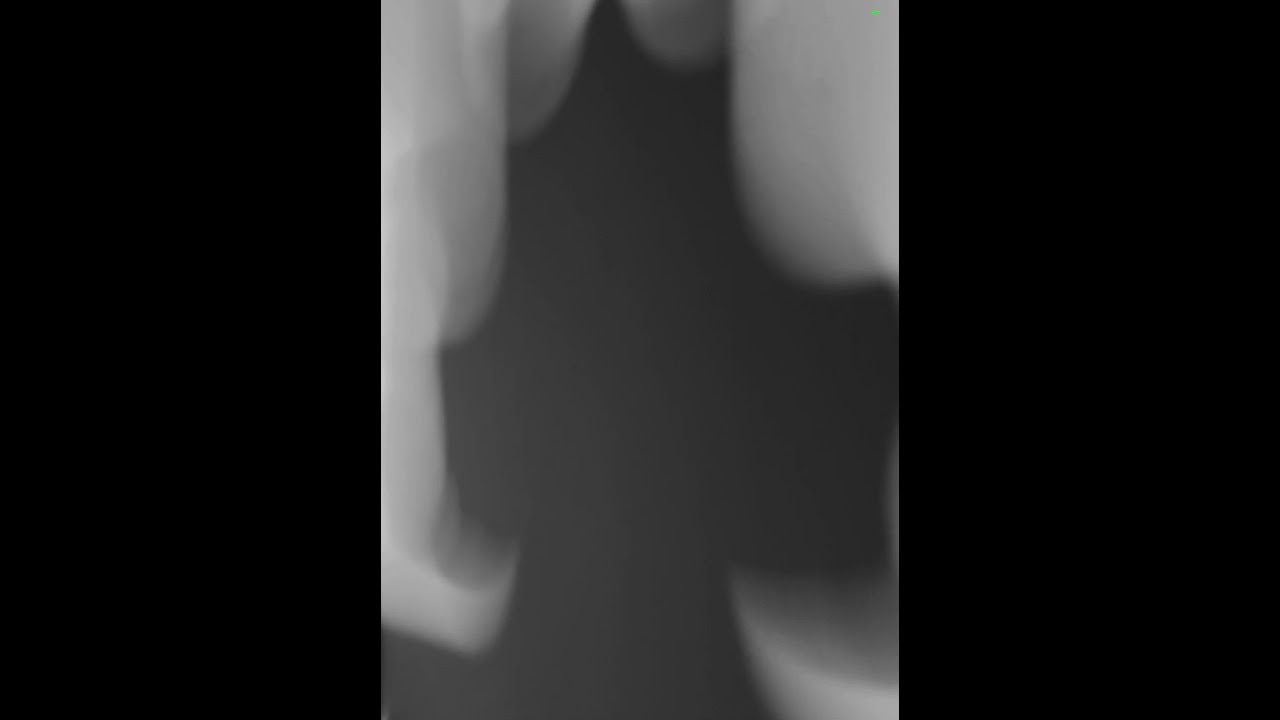 Positive Overlay Shadow Study