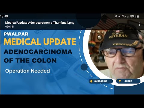 Adenocarcinoma of the Colon Pwalpar Medical Update