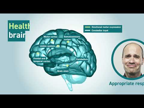 PBA and the Brain | NUEDEXTA® (dextromethorphan HBr and quinidine sulfate)