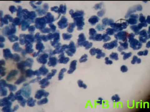 AFB in Urine : Renal Tuberculosis