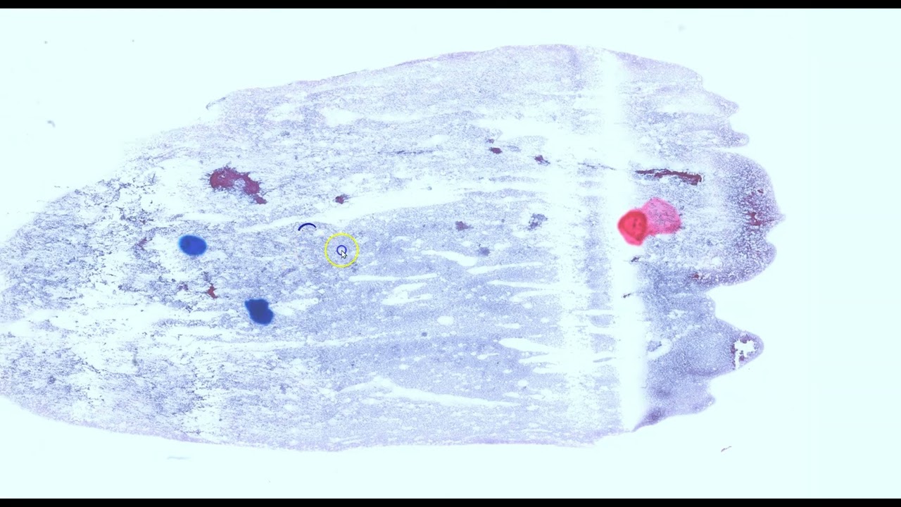 Cytology - Lymph node: Kikuchi disease