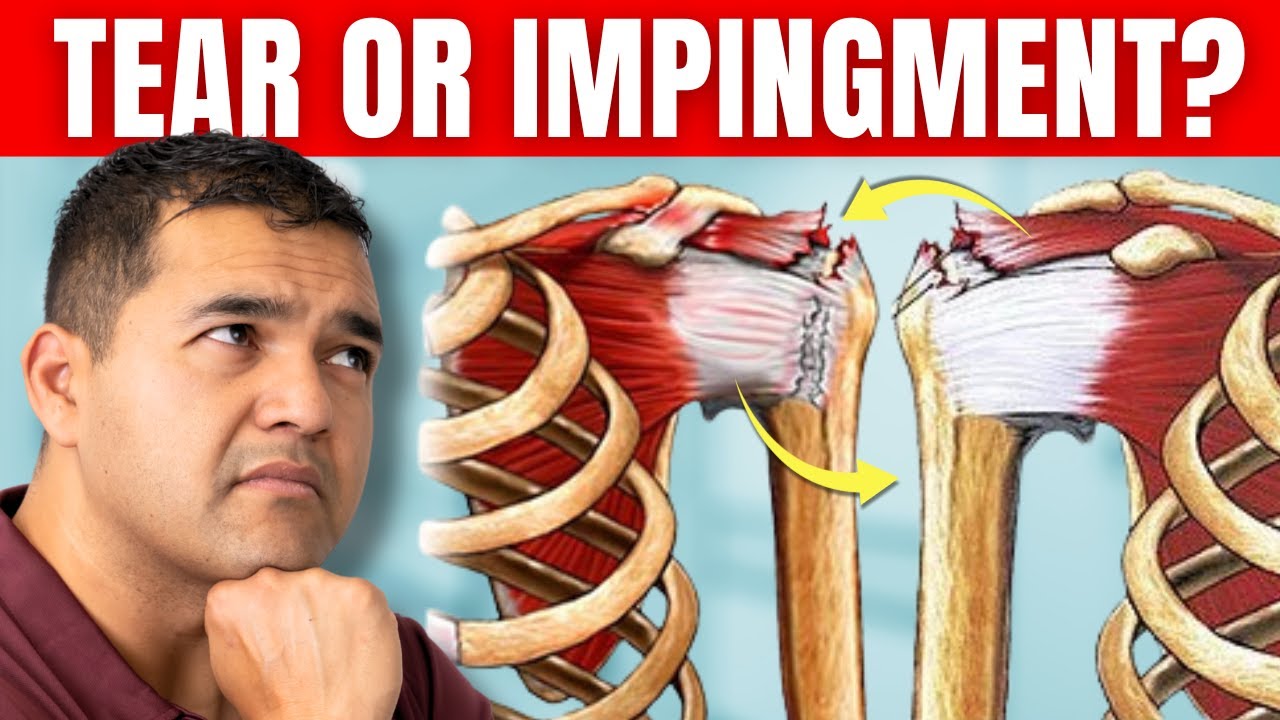 Is Your Shoulder Pain a Rotator Cuff Tear or Impingement? (How to Tell)