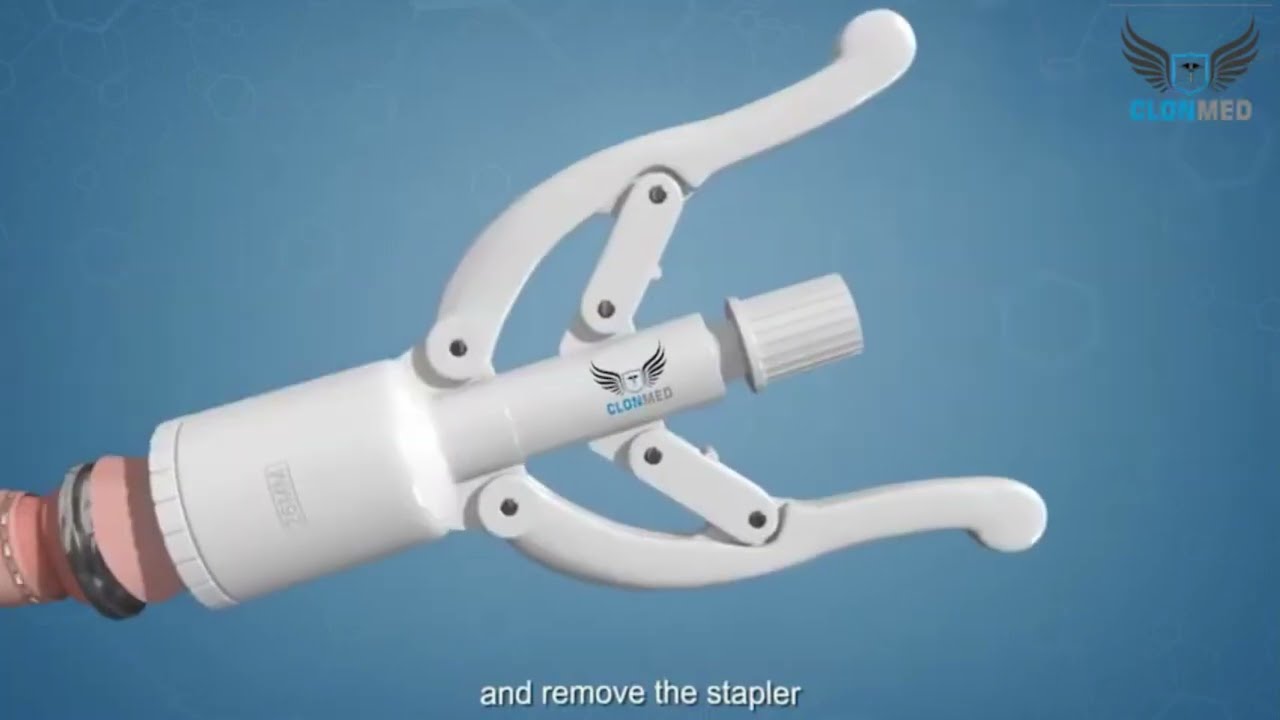 Circumcision Staplers from CLONMED Explained