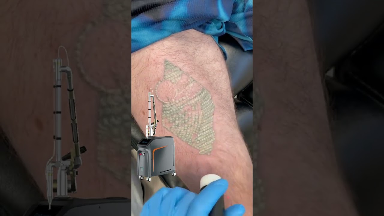Pico laser machine, best for tattoo removal 💯💯💯