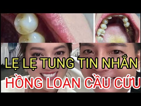 NHA KHOA QUỐC TẾ TUNG TIN NHẮN HỒNG LOAN NGỜ VẢ